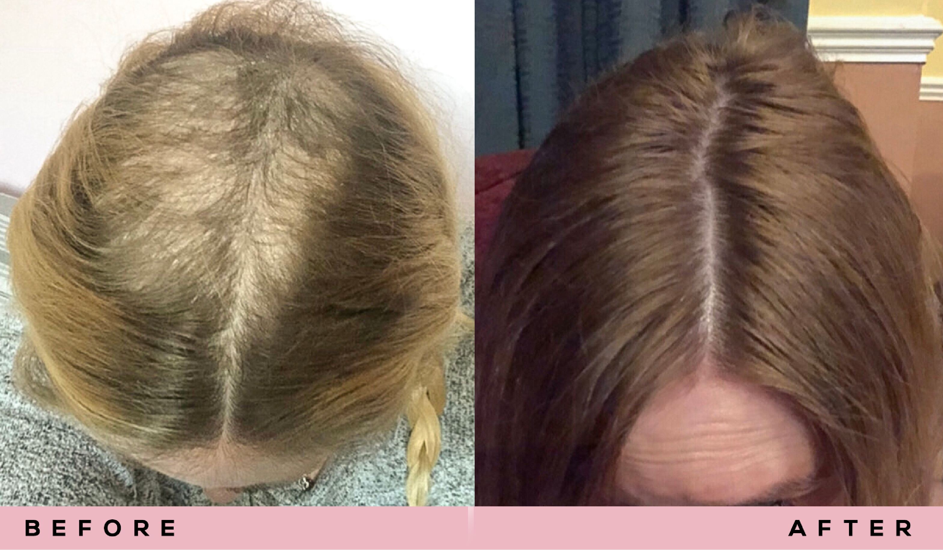 Hair Loss During Lockdown: Five Key-Workers Reveal How Hair Gain Resto ...