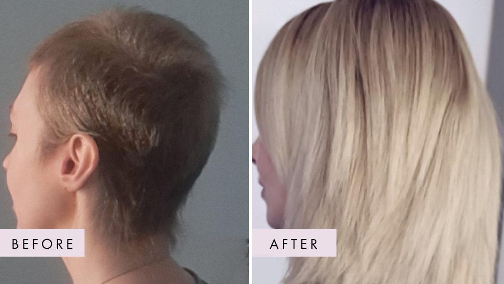 Mum-of-three Shares How Hair Gain Helped Hair Growth After She Lost 95 ...