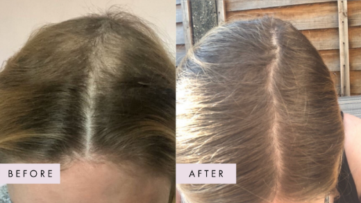 Hair Gain Results - Hair Gain Now