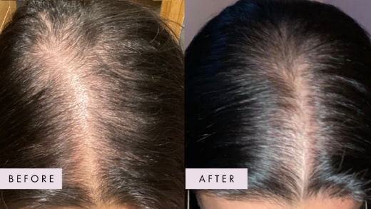 Hair Gain Results - Hair Gain Now