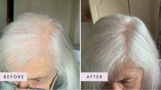 Hair Gain Results - Hair Gain Now